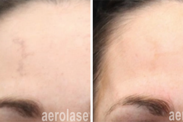 Aerolase Laser in Katy, TX | Hibiscus Aesthetics & Wellness